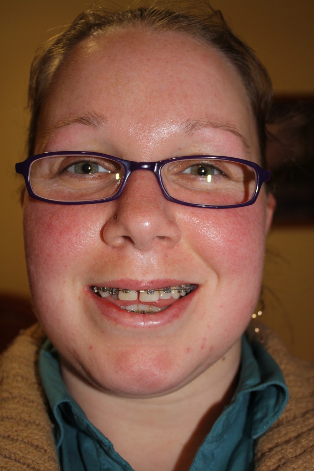 Braces + SARPE/SARME Surgery