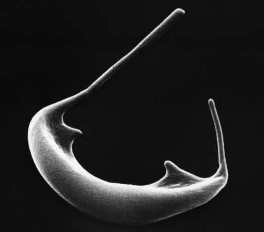 Esprit Scientifique: Aperçu de la drépanocytose