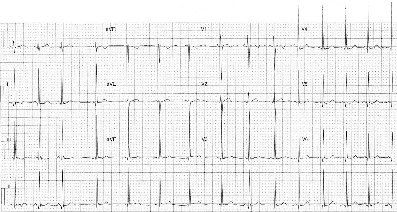 ECG of the Week: ECG of the Week - 17th July 2017 - Interpretation