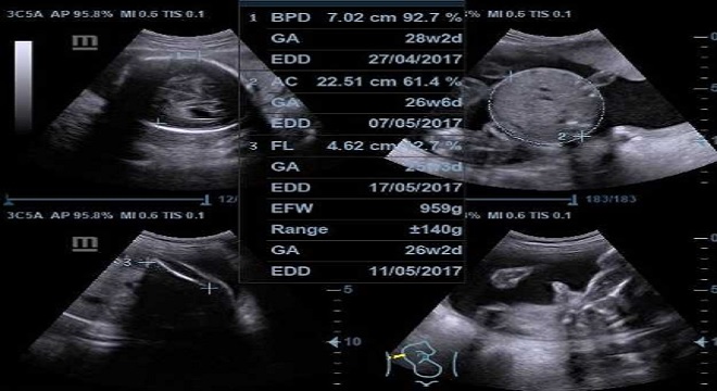 Ibu Hamil Wajib Banget Tahu, Begini Cara Membaca Foto Hasil USG ...