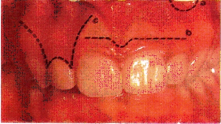 Interdental: DISAIN DAN TEKNIK PEMBUATAN FLAP PADA PEMBEDAHAN RONGGA MULUT