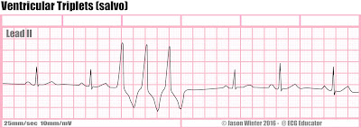 ECG Educator Blog : Ventricular Triplets (salvo)