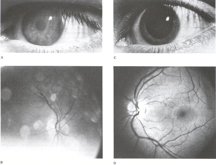 Dr. Saif ALaa ALqaisy: Fundoscopy and Interpret the findings in a ...