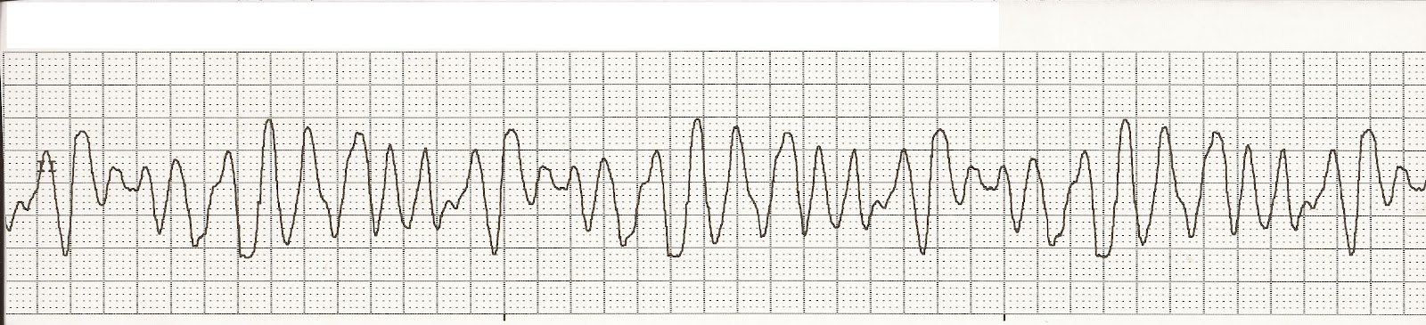 EKG Rhythm Strip Quiz 80