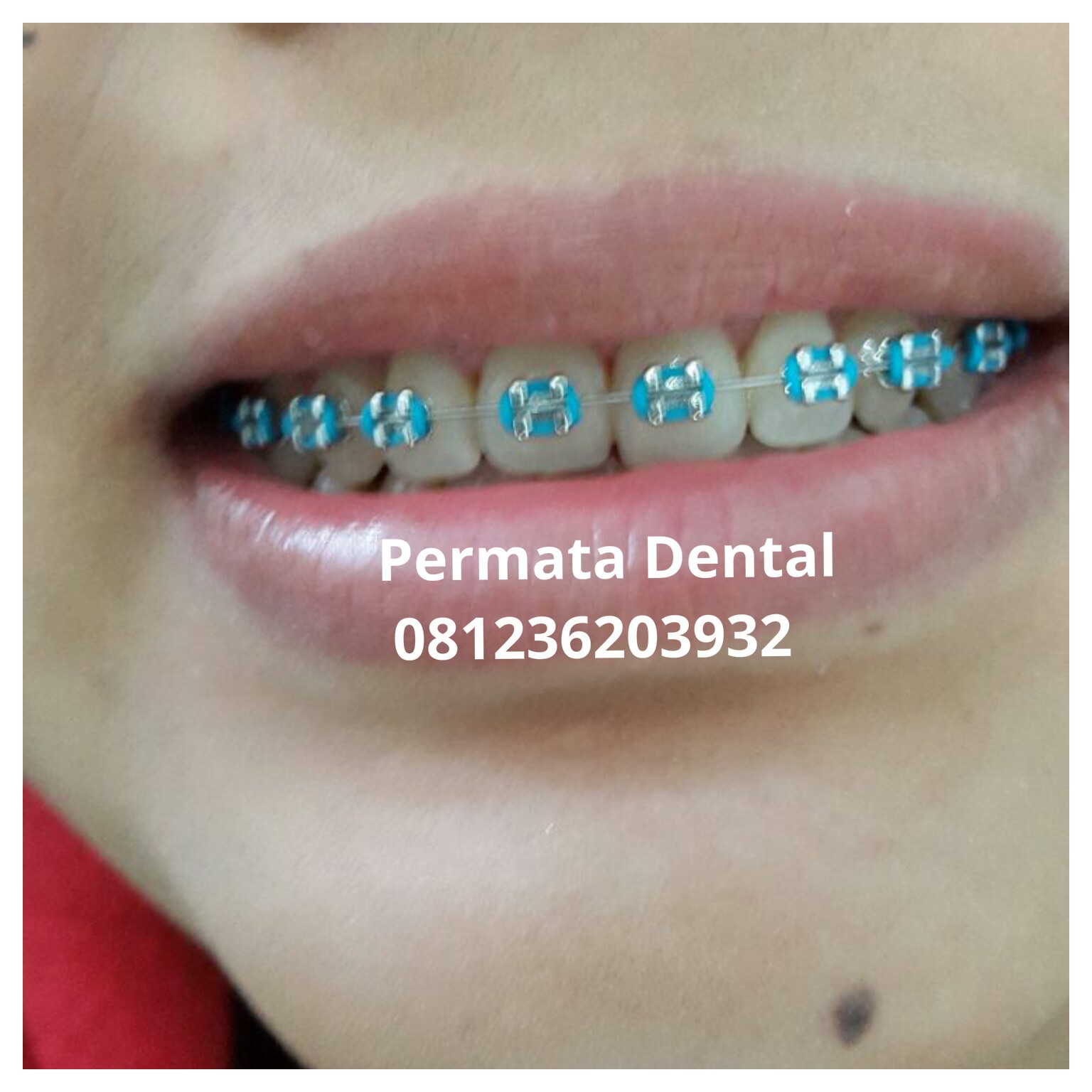 Klinik Gigi Jember Permata Dental : Behel | Bracket | Kawat Gigi Untuk ...