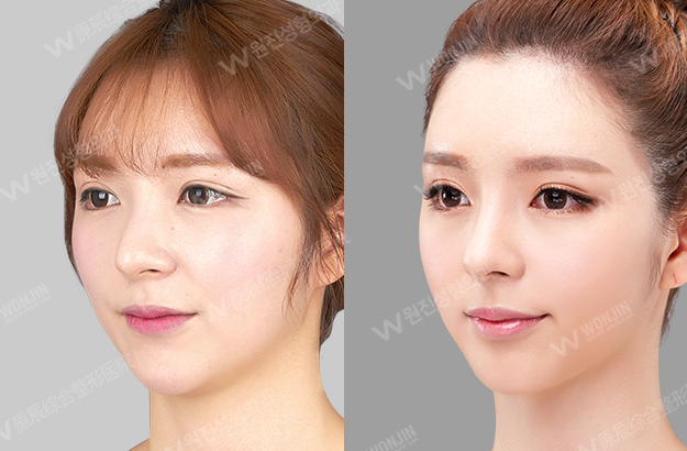 Hidung Panjang dapat menjadi penyebab anda terlihat lebih tua