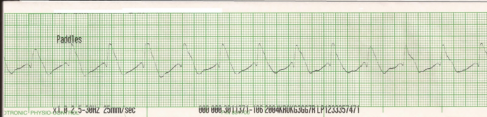 Megacode Pulseless VF/VT Part 1