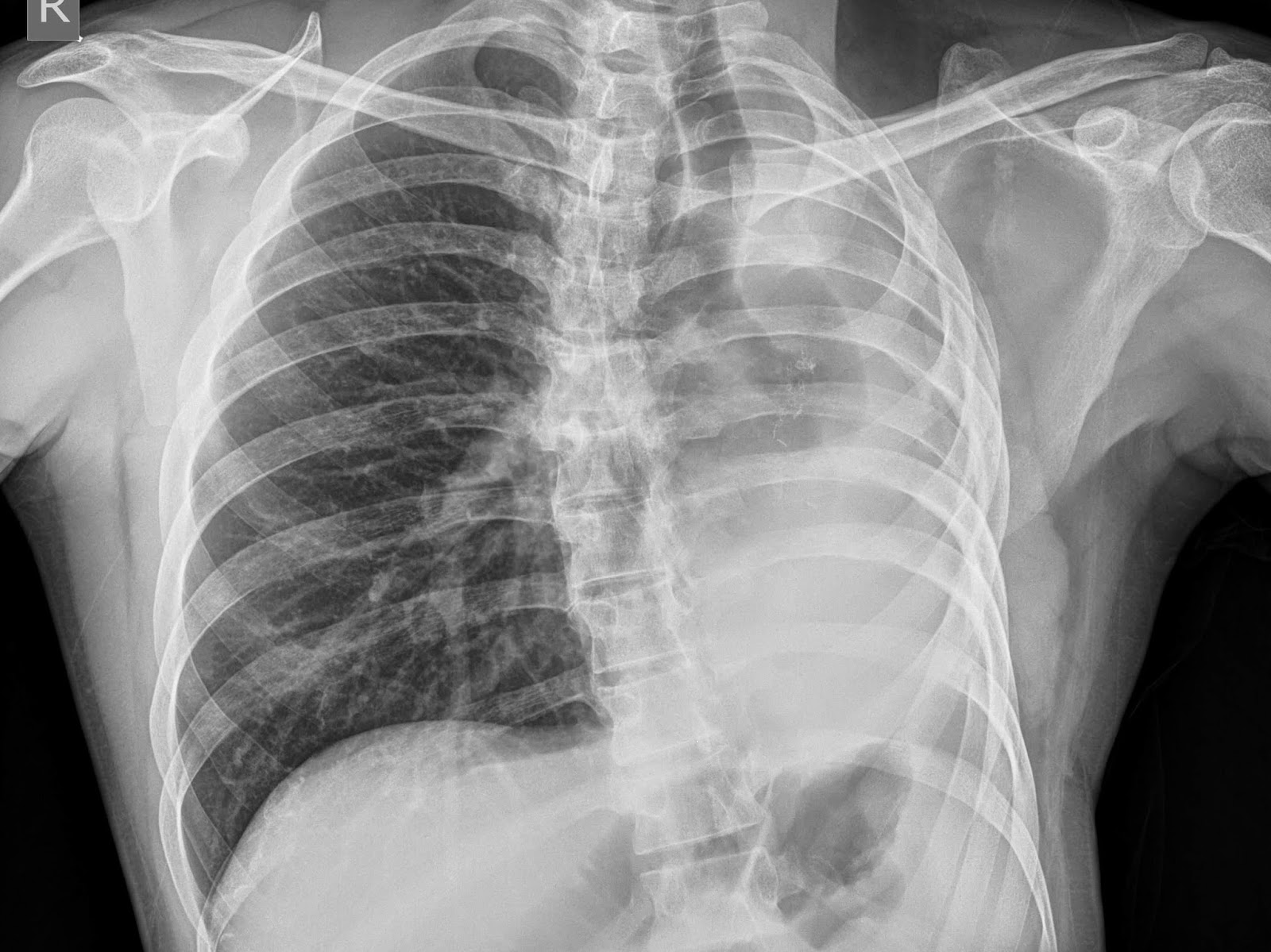 Pneumonectomy-CXR - Sumer's Radiology Blog