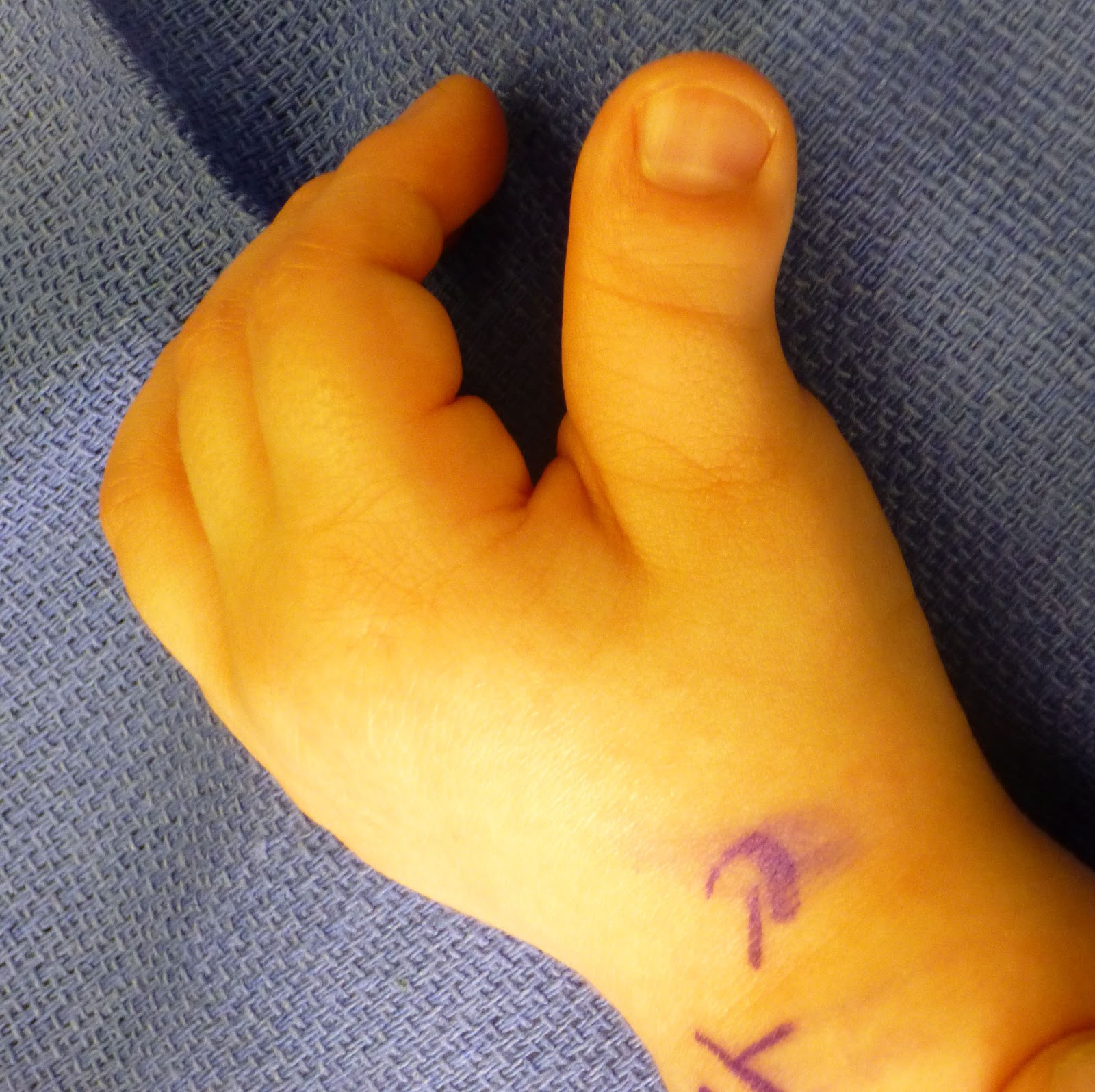Clinodactyly | Congenital Hand and Arm Differences | Washington ...