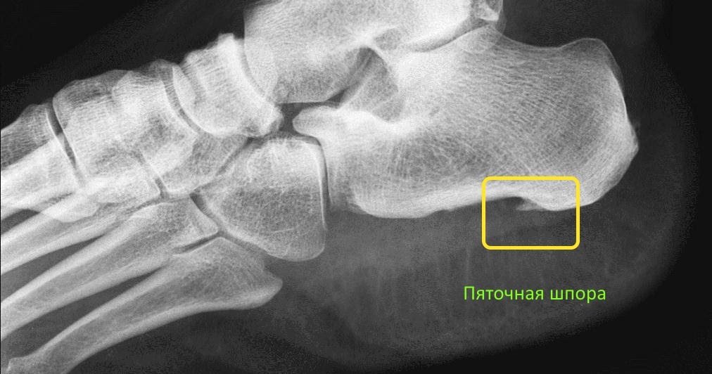 ТРАВМАТОЛОГ - ОРТОПЕД, ПАВЛОВСКАЯ: Лечение пяточной шпоры в станице ...
