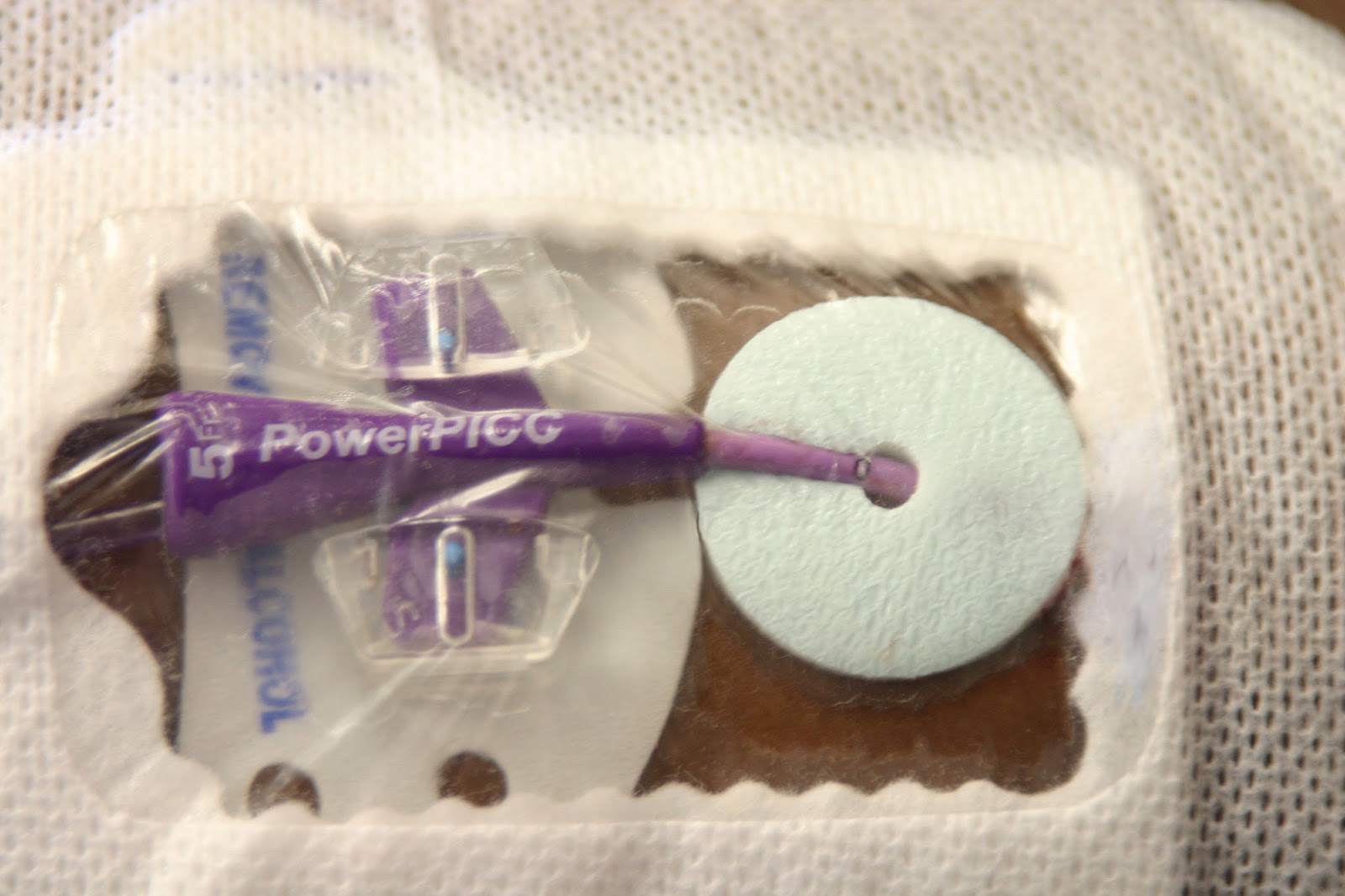 POSIZIONAMENTO DI PICC E MIDLINE – a cura di Lorenzo D’AMICO ...