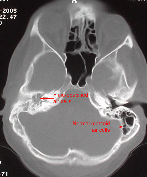 Anaerobic Infections: Upper Respiratory Tract Infections Caused by ...