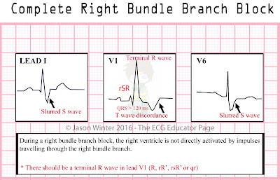 ECG Educator Blog : Bundle Branch Blocks