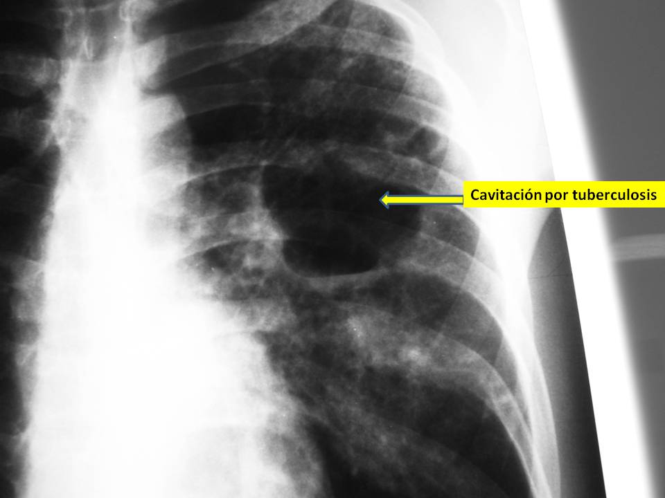 SaludRespiratoria: Tuberculosis..un tabú en la actualidad