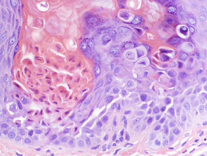 VIRTUAL GRAND ROUNDS IN DERMATOLOGY 2.0: Keratosis Follicularis