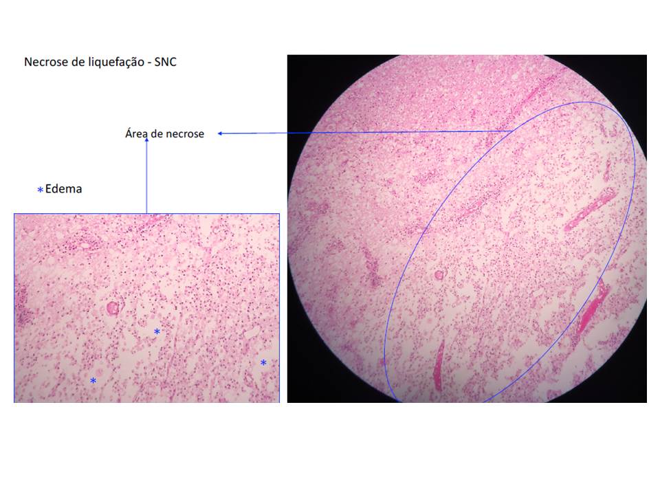 HISTOLOGIA90: TIPOS DE NECROSE