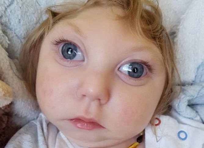 Cissas Blog: Baby born with half his skull missing beats all odds to ...