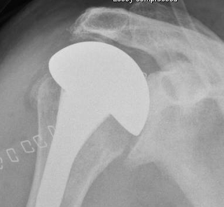 Shoulder Arthritis / Rotator Cuff Tears / Shoulder Pain : Cuff tear ...