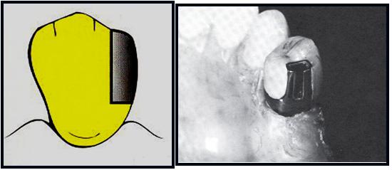 Dentistry lectures for MFDS/MJDF/NBDE/ORE: Attachments and their use in ...