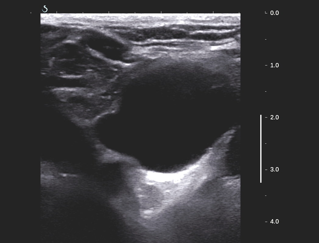VIETNAMESE MEDIC ULTRASOUND: CASE 396: PARATHYROID CYST, Dr PHAN THANH ...