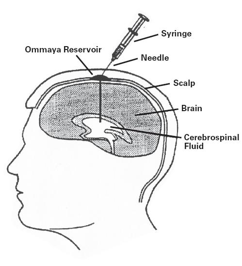 my 2012 experience with breast cancer: Ommaya reservoir