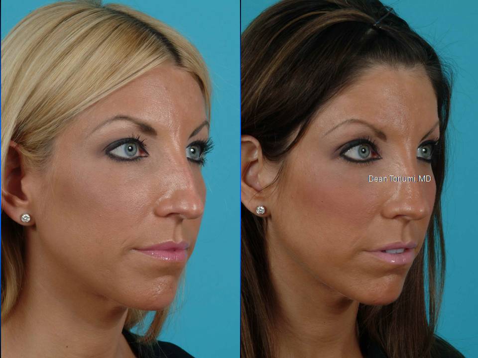 Dr. Dean Toriumi Reviews: Dean Toriumi Reviews: Patient presented with ...