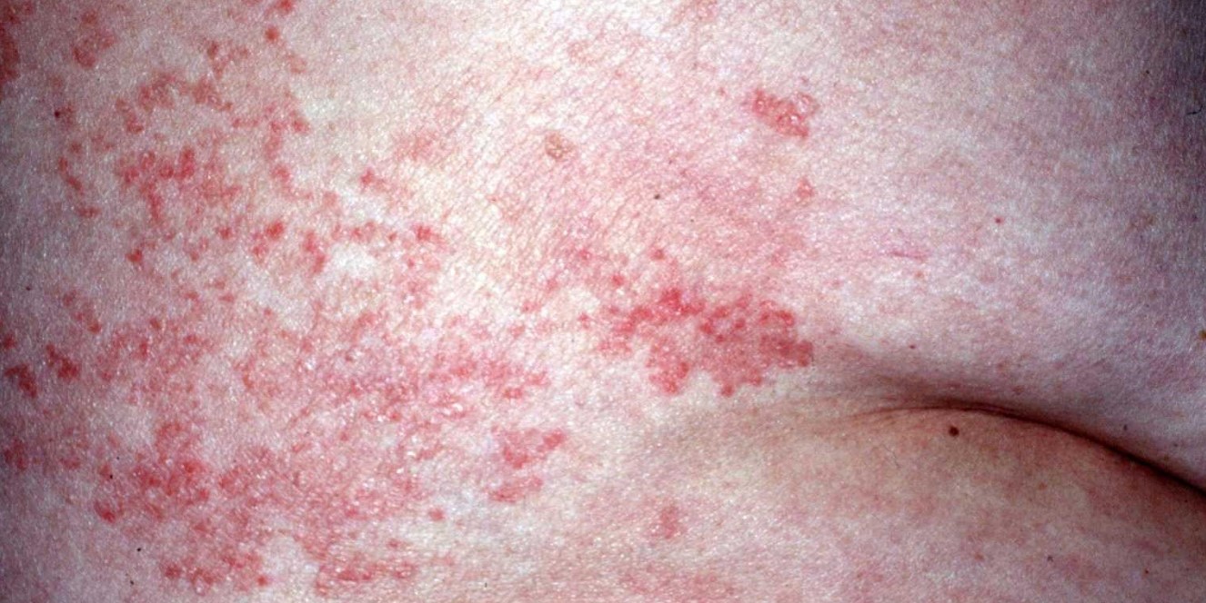 Tinea incognito Nedir? Belirtileri, Nedenleri, Tanısı ve Tedavisi