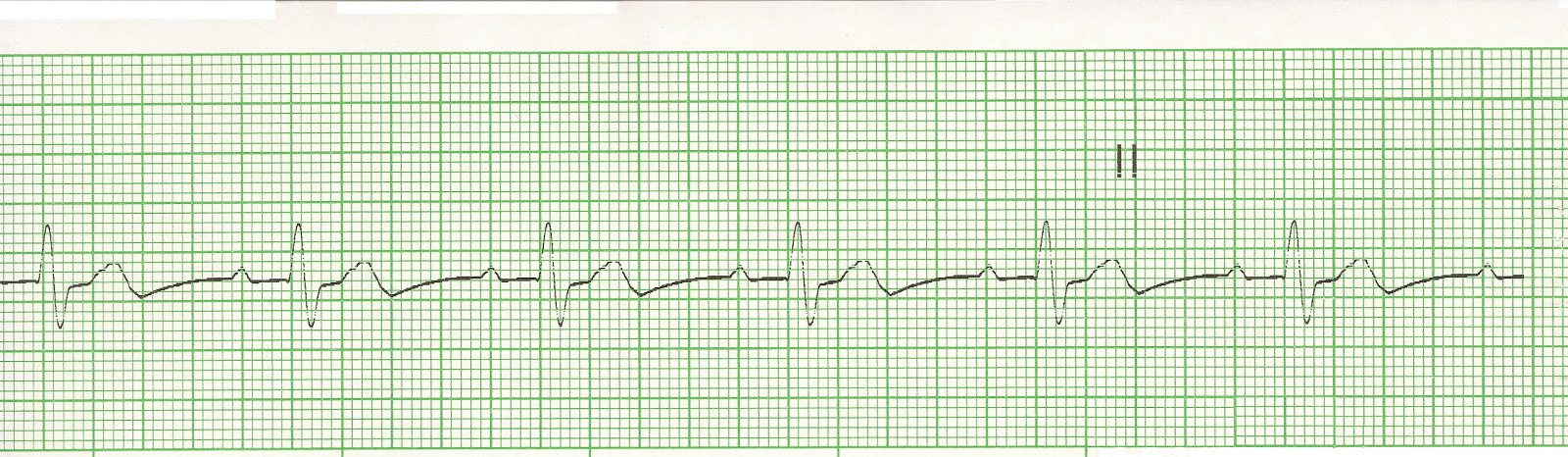 EKG Rhythm Strips 03
