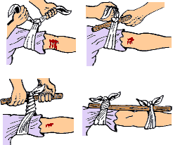 4.2 Hemorragias externas