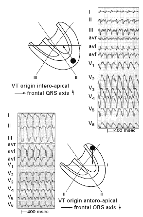 My Variables Only Have 6 Letters: EKG Myth - "Can't be Ventricular ...