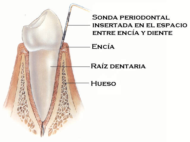 PROMOCION Y PREVENCION: ENFERMEDAD PERIODONTAL