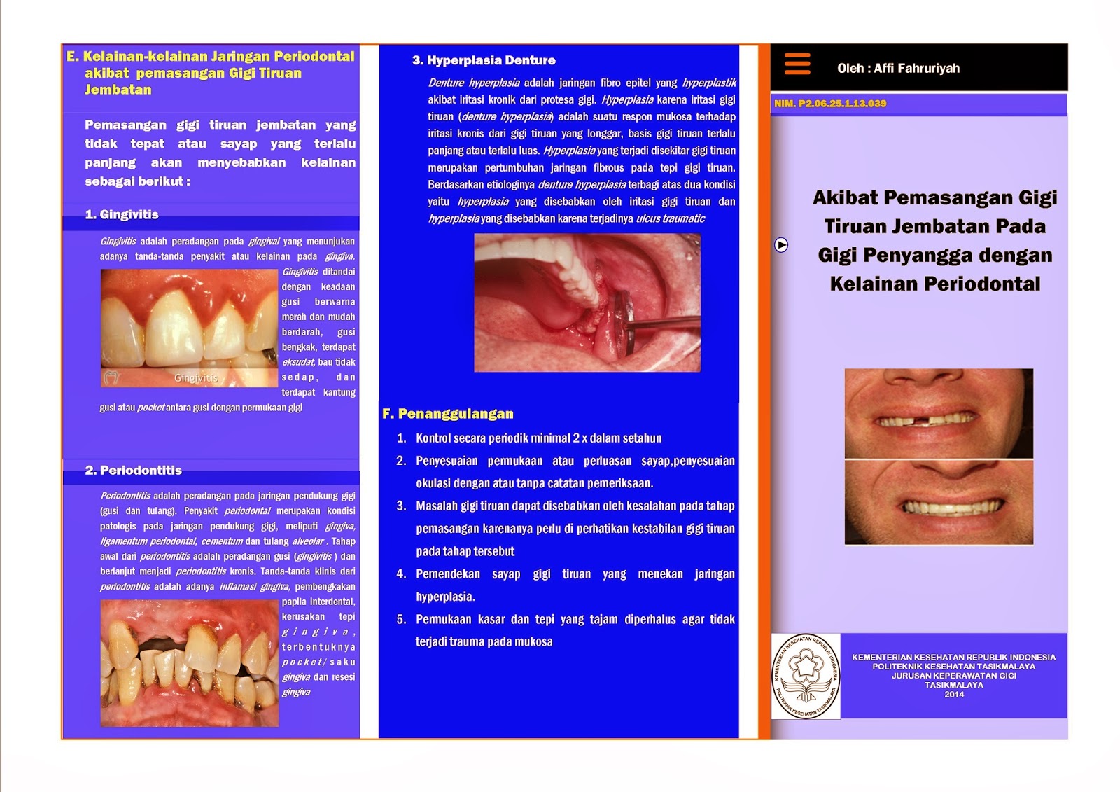 Pemasangan Gigi Tiruan Jembatan dengan Kelainan Periodontal: Brochure