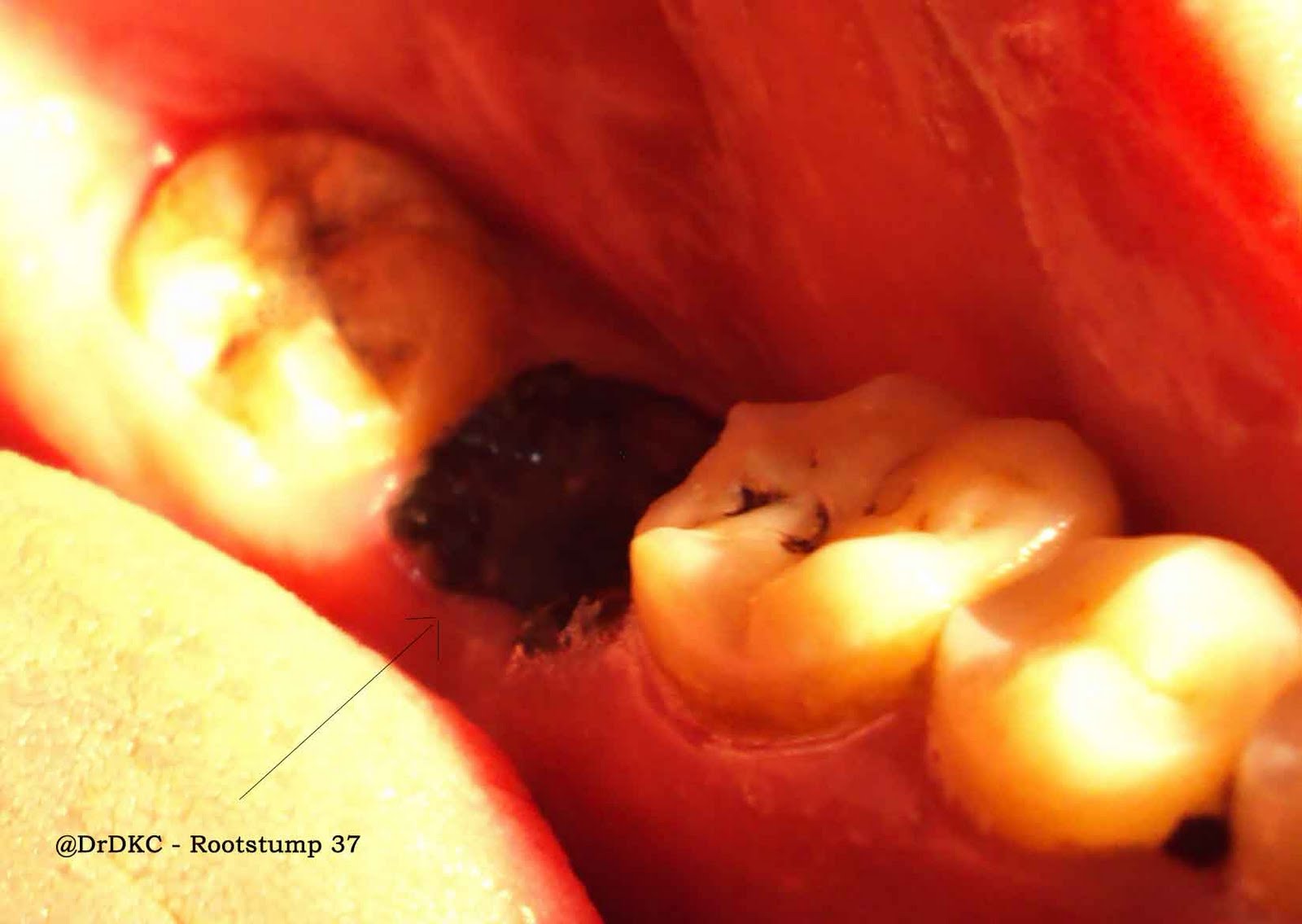 What is a Periapical Infection