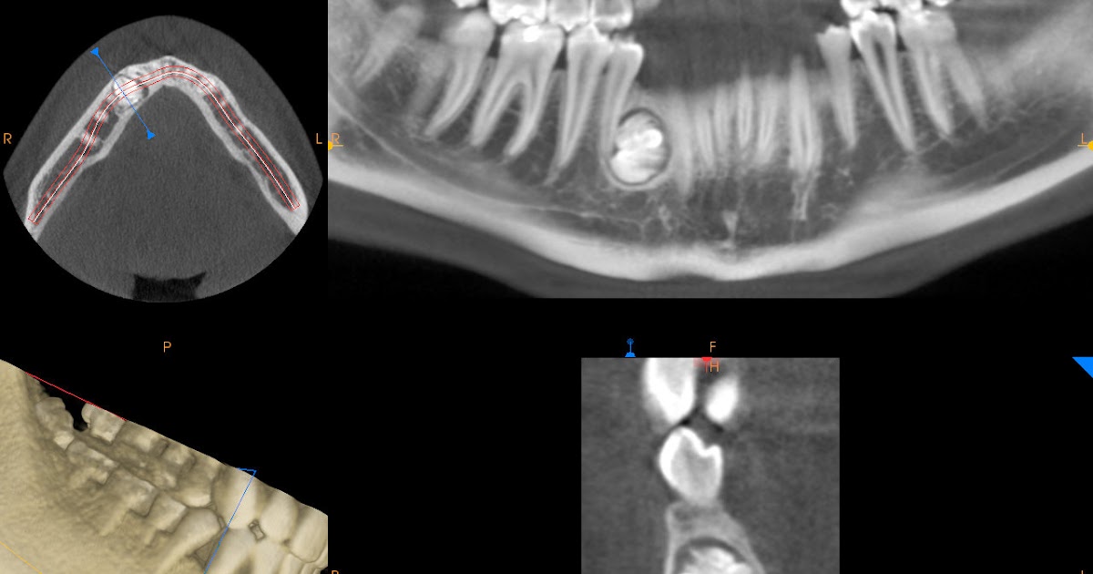 Dr. Gabbaypour, DDS, MD: Odontoma