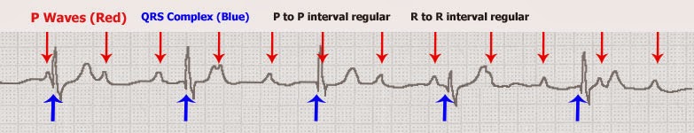 3rd Degree AV Block | INA - ECG