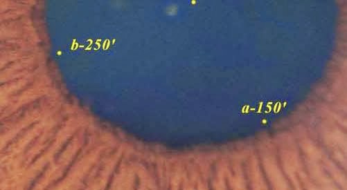 Modern & Multidimensional Iridology: IPB, Pupil, Pupillary Zone ...