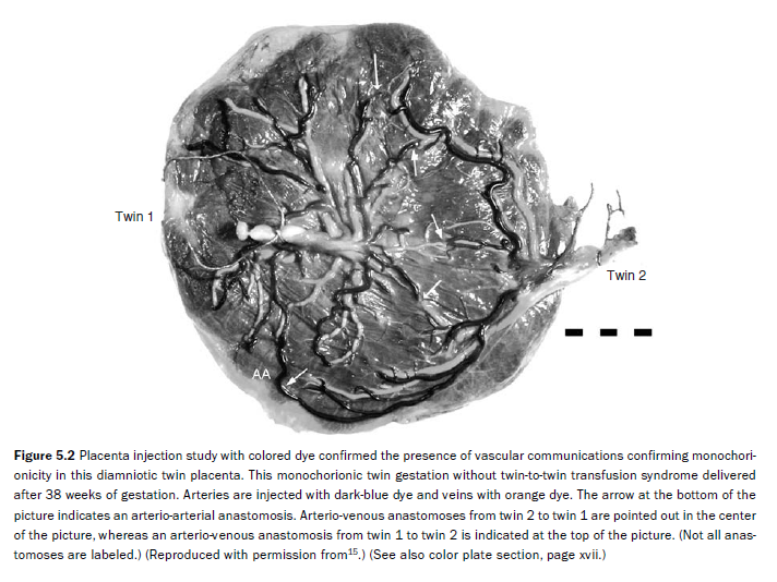 The Monochorionic Placenta | Twin-Twin Transfusion Syndrome (TTTS)