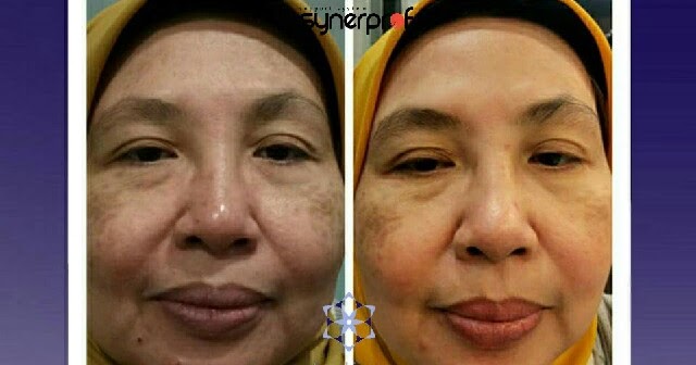 foto bopeng pada wajah