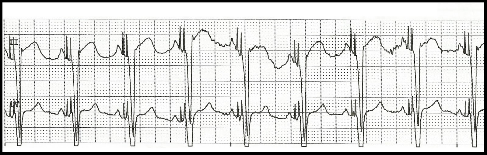 EKG Rhythm Strip Quiz 144