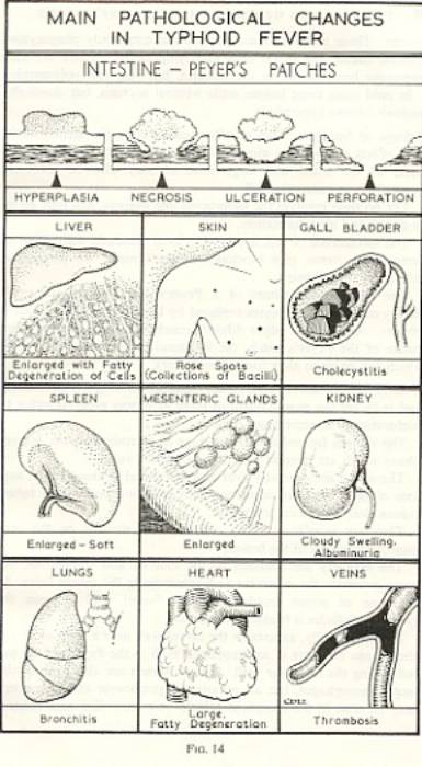 All about Typhoid fever