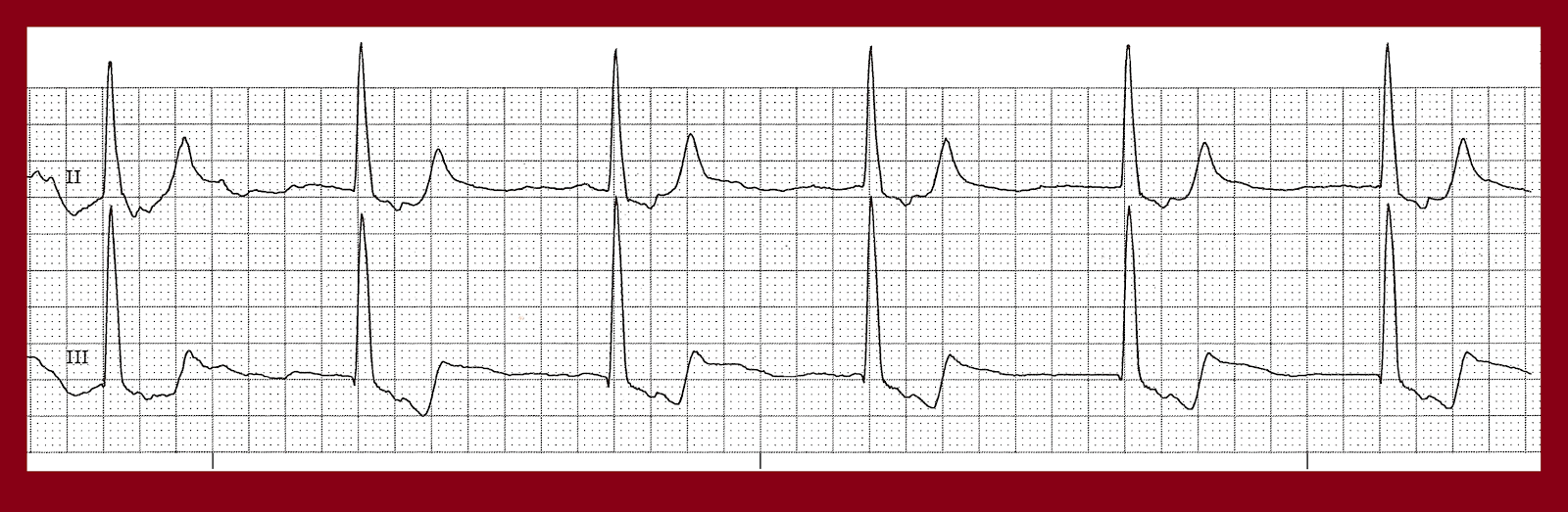 Float Nurse: Various Junctional Rhythms