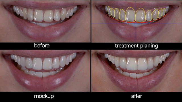Smile Design - Makeover ~ Dr. Bharat Katarmal Dental & Implant Clinic