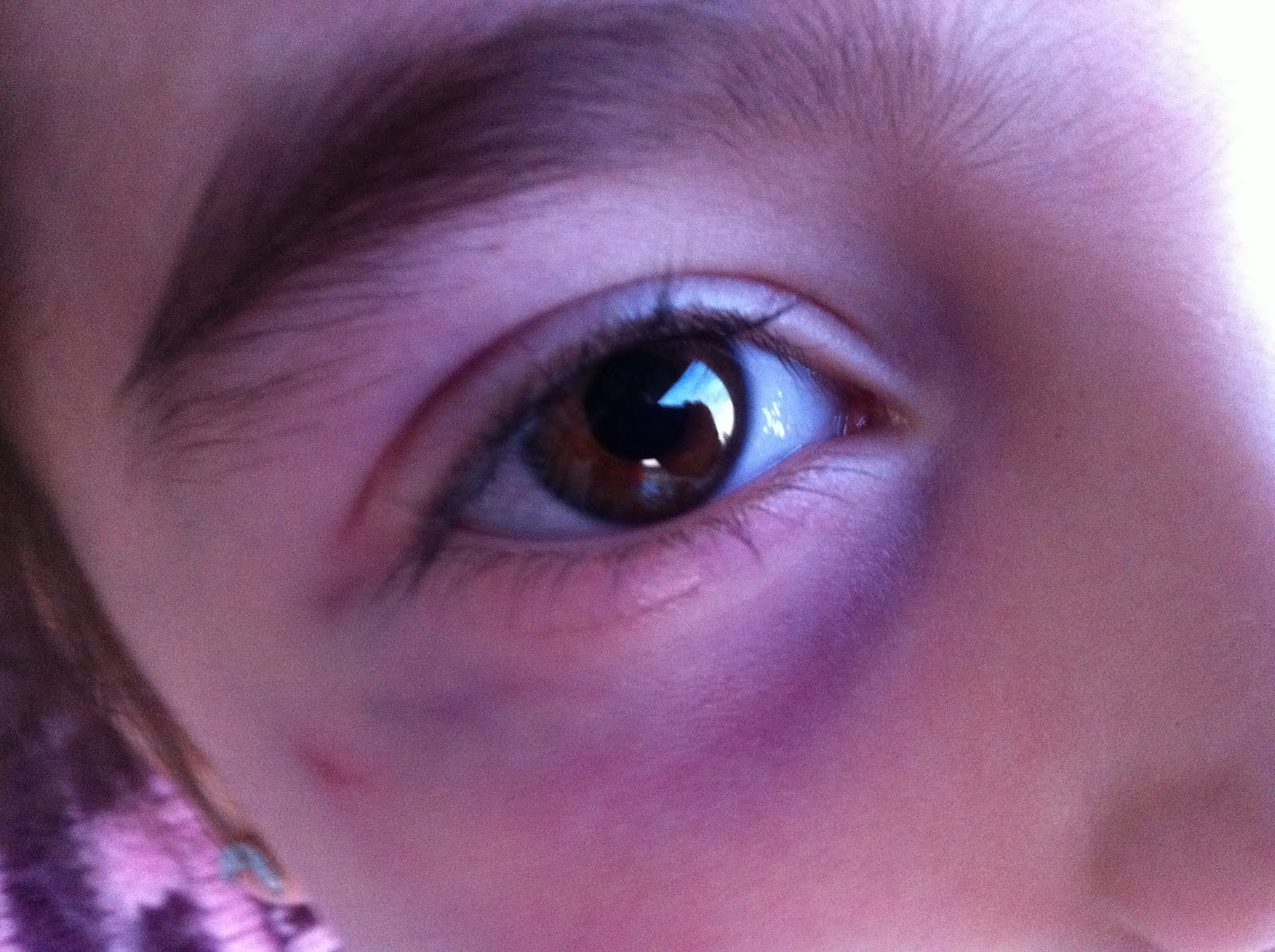 100% Mamá: Accidente, un ojo morado