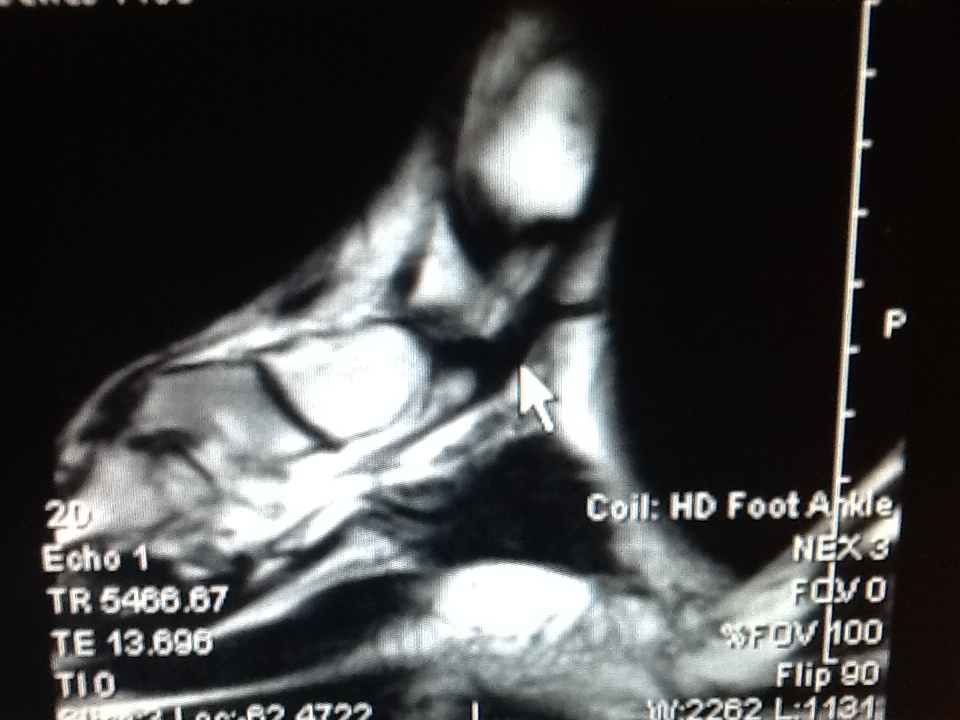 Foot and Ankle Problems By Dr. Richard Blake: Images for Os Navicularis ...