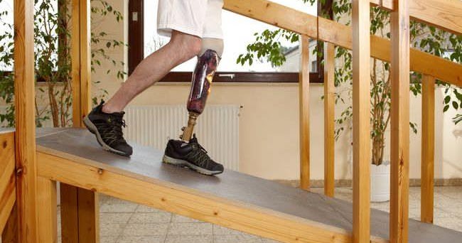 What Is Amputation? | All About Backlinks Here