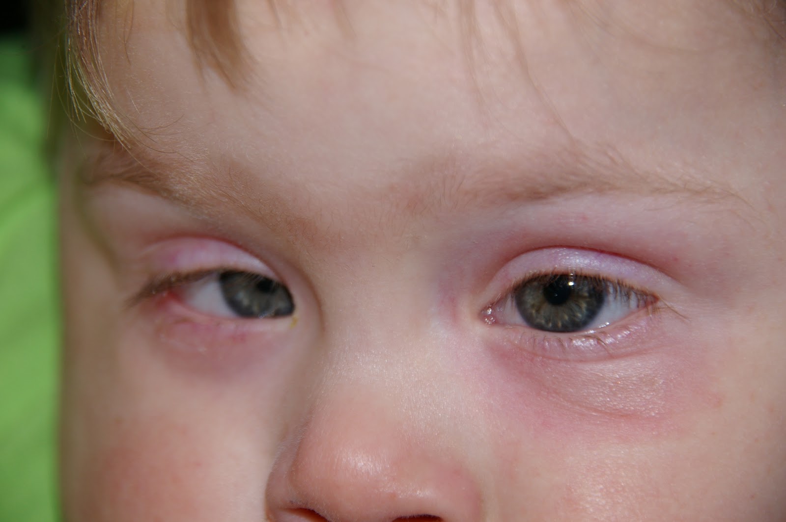 Jerrys Welt: Bindehautentzündung...