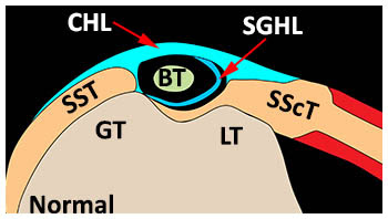 MRI Musculo-Skeletal Section: Long head of biceps dislocation grading.