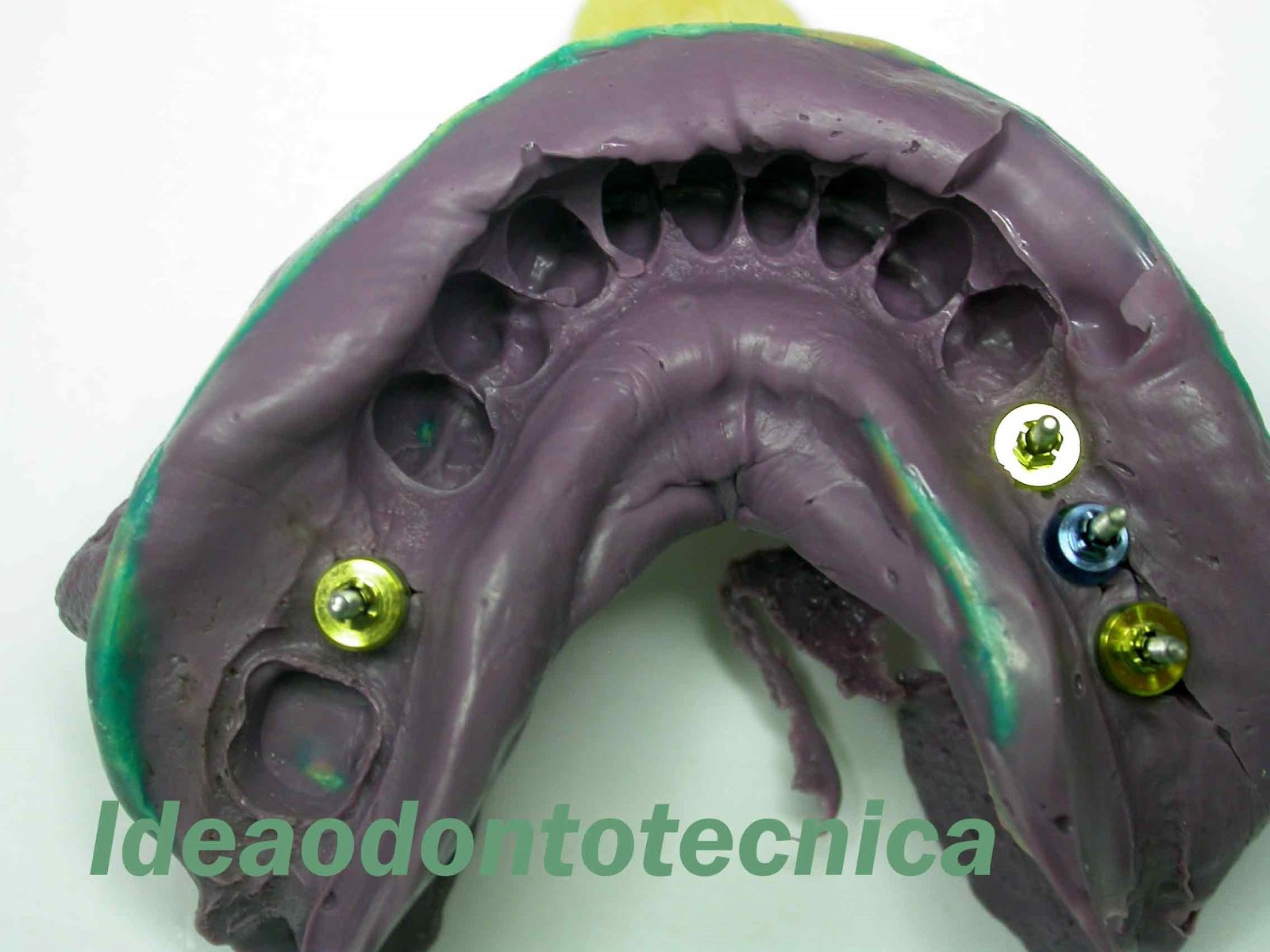 Ideaodontotecnica : L'impronta in implantologia