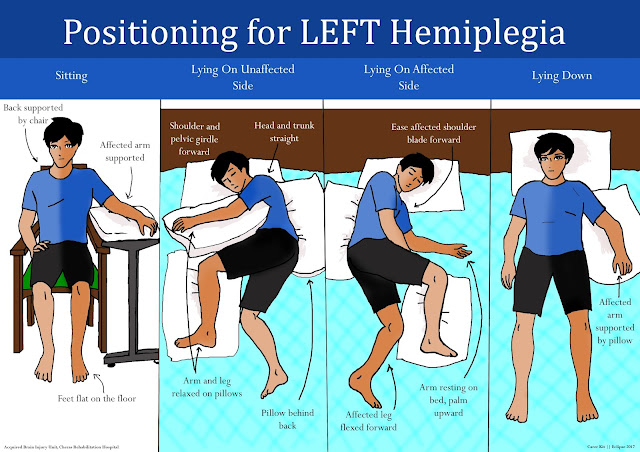 Carer Training Information: Positioning for Left Hemiplegia