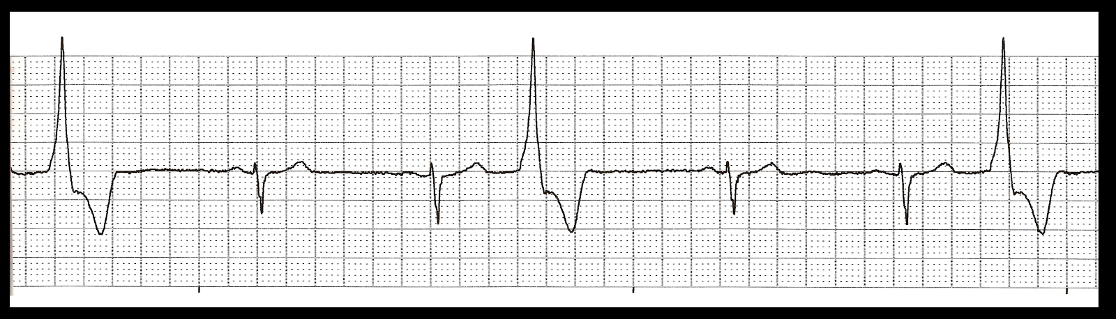 Practice EKG Strips 411
